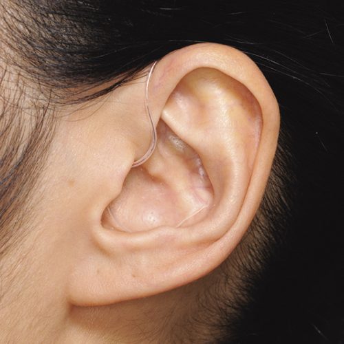 補聴器の種類 | ボイス補聴器センター